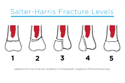 FAQ on Growth Plate Fractures by Todd Gaddie, MD, Orthopedic Surgeon